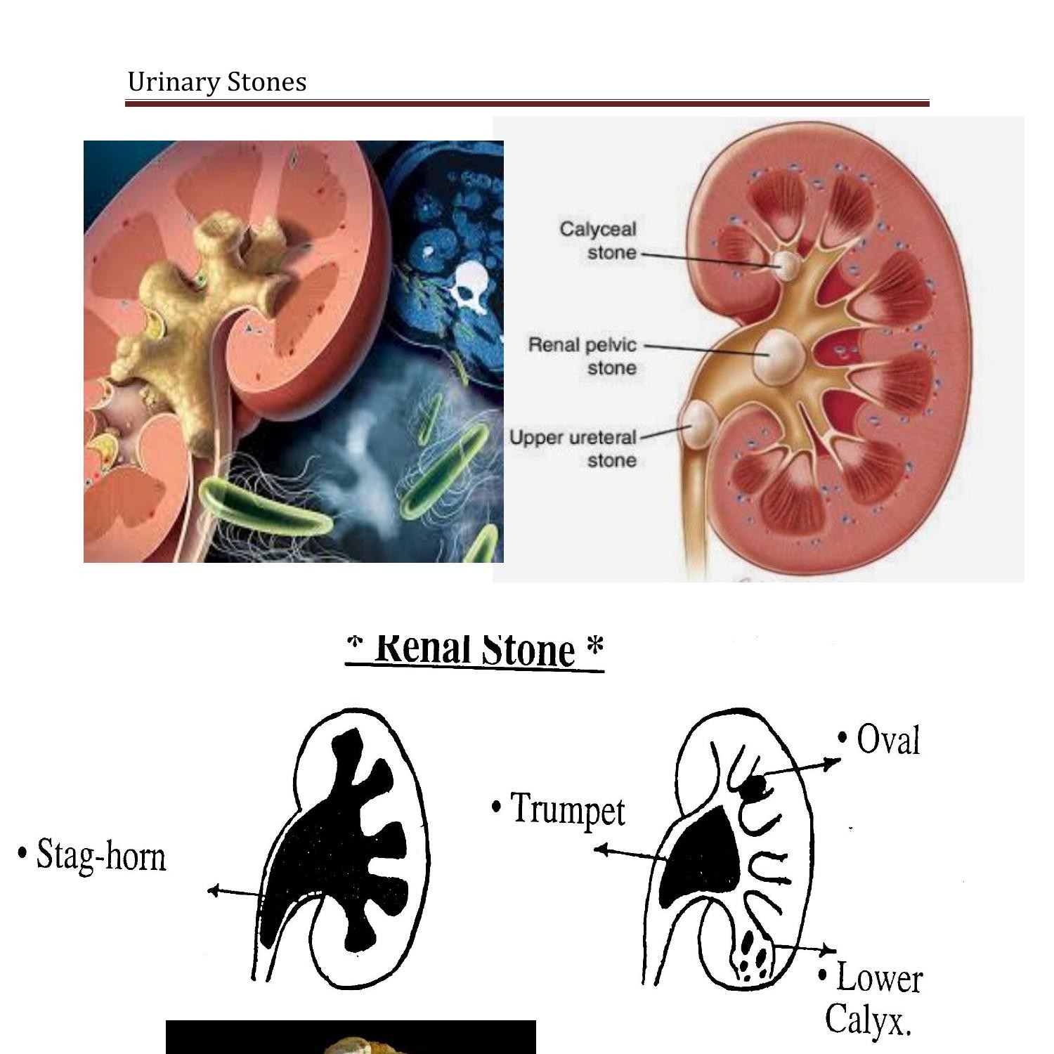 Urosurgery -Renal Stones.doc | DocDroid